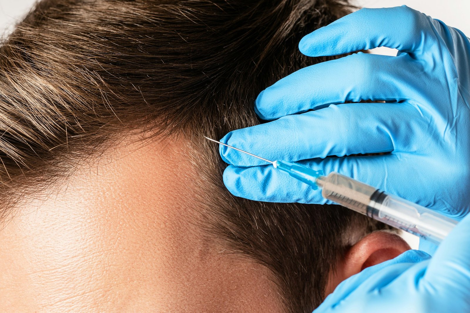 Best PRP Hair Treatment In Bangalore | PRP For Hair Loss